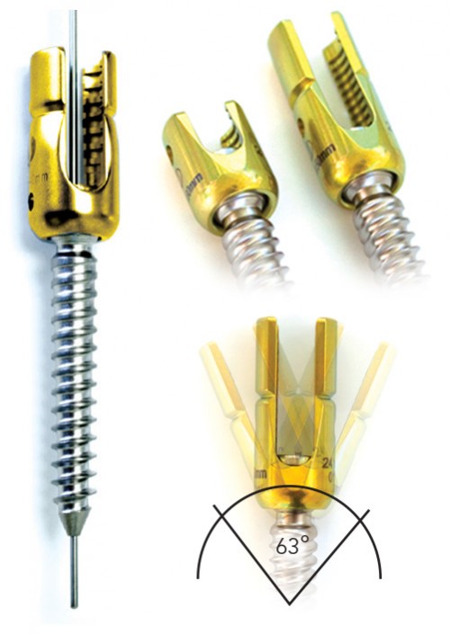 CapLOX II Pedicle Screw System - Pedicle Screws and Rods