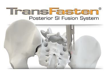 TransFasten Posterior SI Fusion System - Announcing Alpha Launch