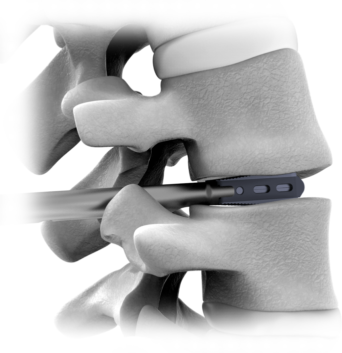 Expandable Lumbar Cage System - EquiLOX - MIS Spine Fusion
