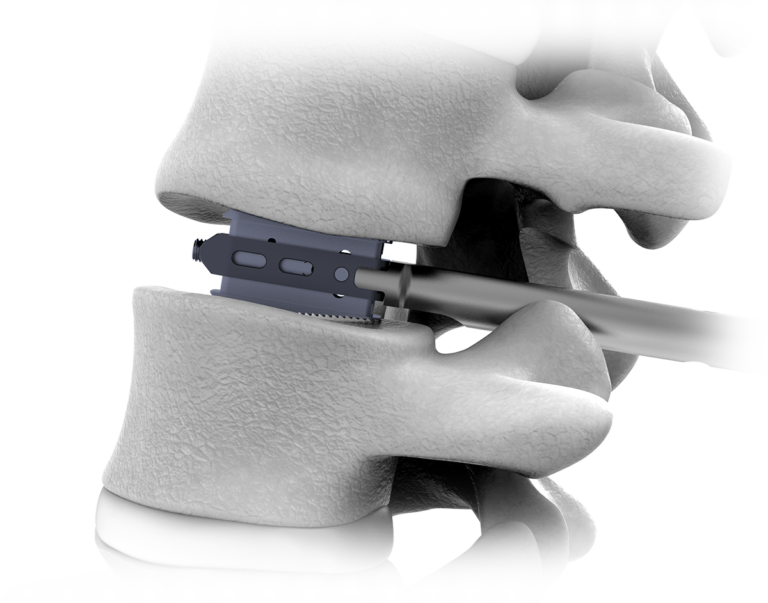 Expandable Lumbar Cage System - EquiLOX - MIS Spine Fusion